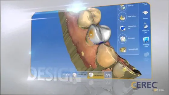 CEREC Same Day Natural-Looking Crowns in Santa Clara, Silicon Valley